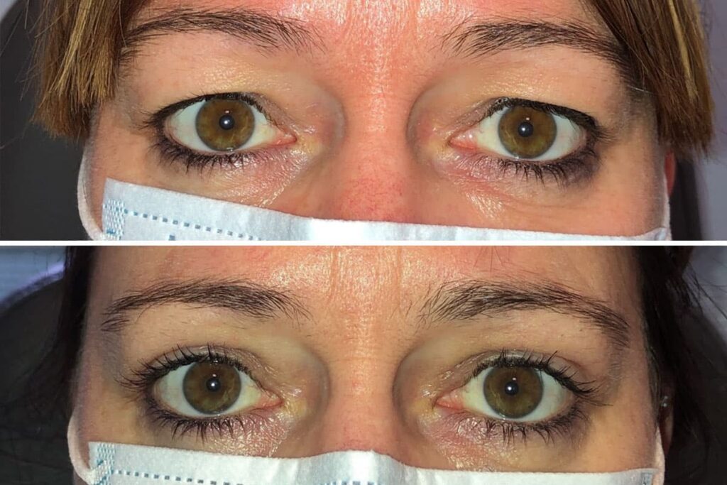 Blépharoplastie Marseille | Chirurgie paupières supérieure et inférieure