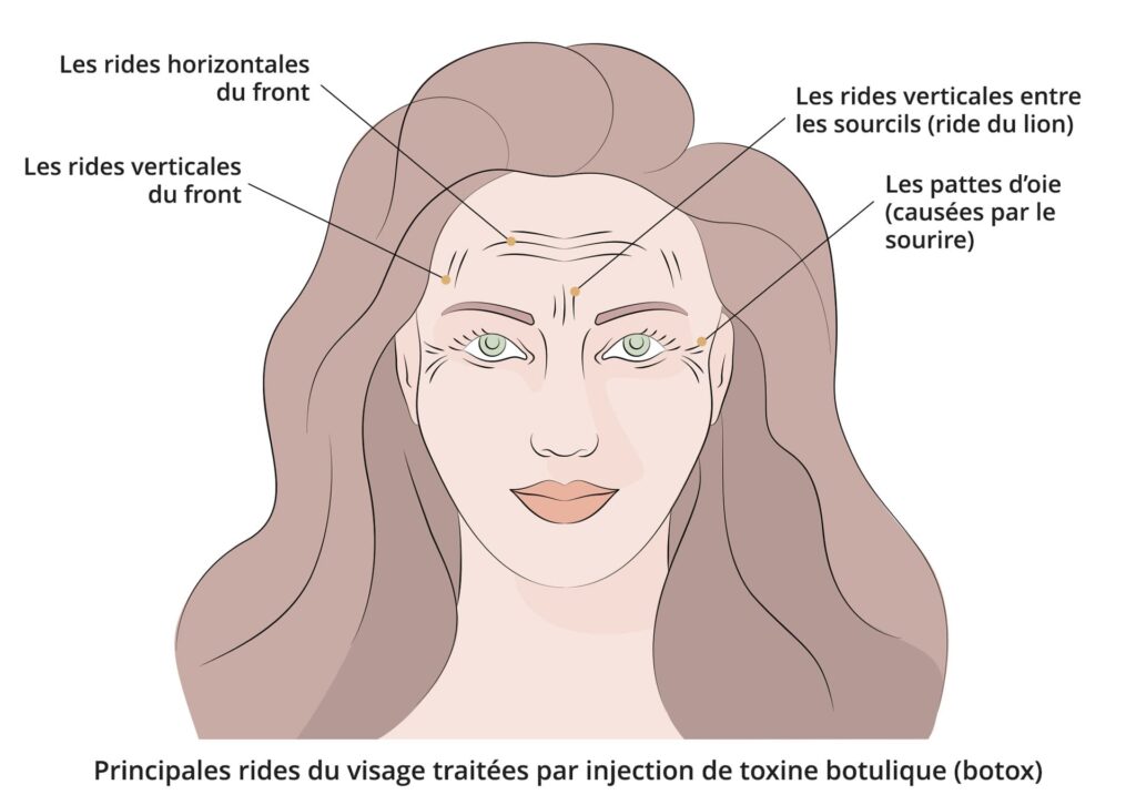 Injections de Botox (toxine botulique) à Marseille | Indications, tarifs